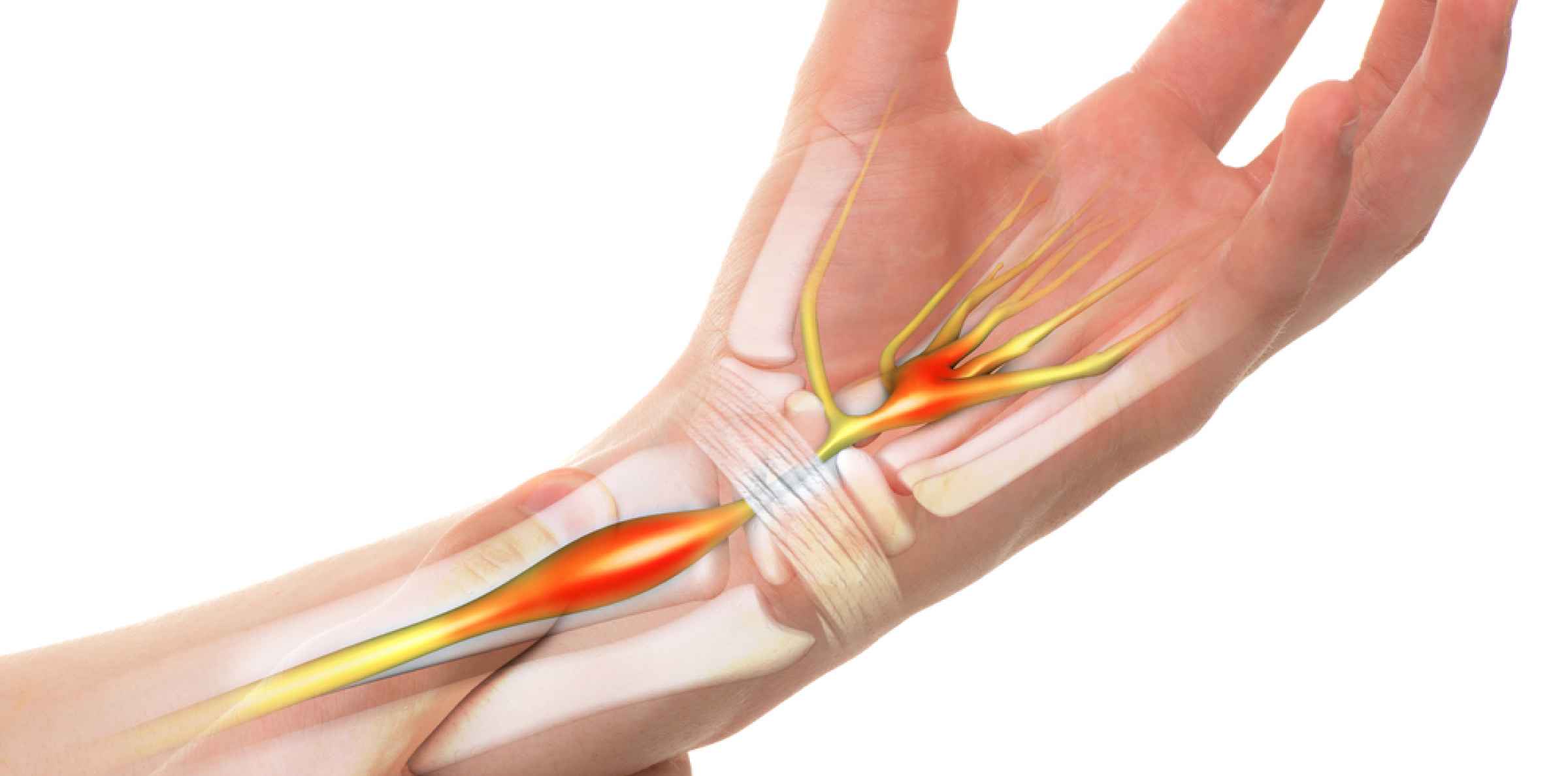 Puutuvatko sormet öisin? Taustalla voi olla rannekanavaoireyhtymä ...