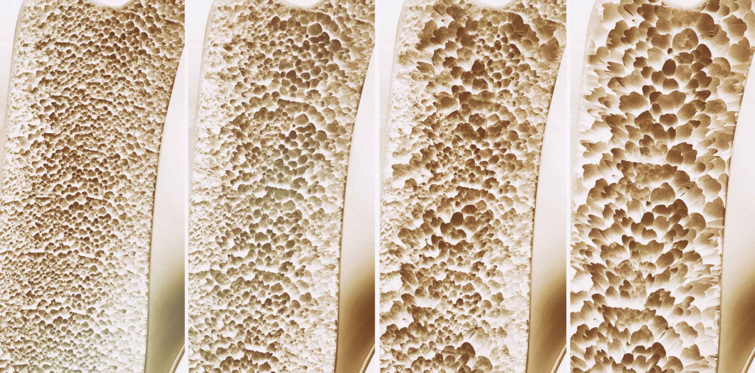 Onko sinulla kortisonilääkitys? Näin voit pienentää osteoporoosin ...
